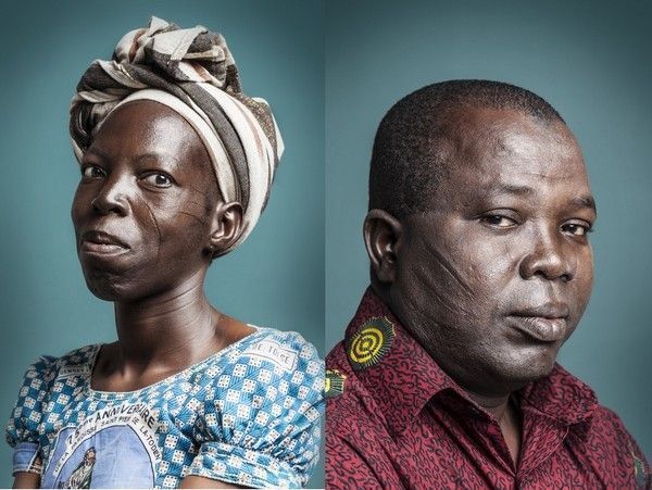 La scarification, une alternative ? | OpenMinded